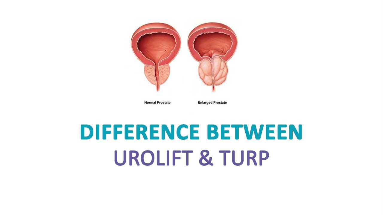 UROLIFT vs TURP Treatments for BPH. - YouTube