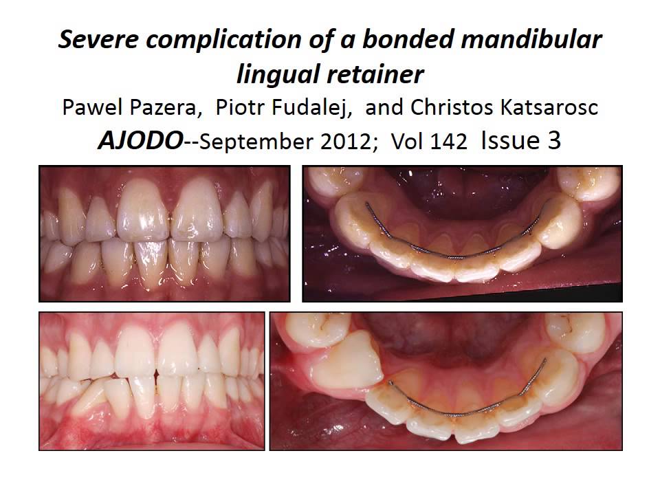 Stainless Steel Ortho Flex Tech- Fabrication -Dr. David Musich - YouTube