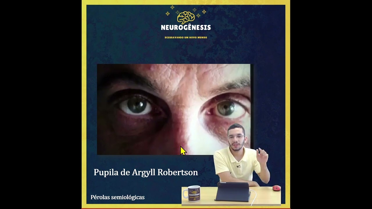 Pupila de Argyll Robertson - neurossífilis - YouTube