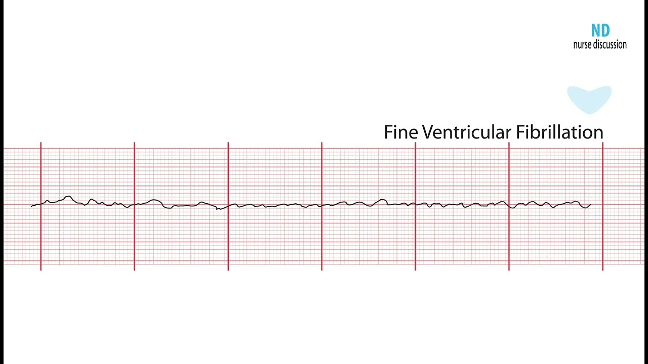 Coarse Ventricular Fibrillation