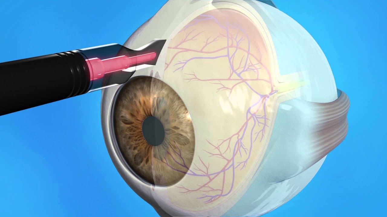 Glaucoma Cyclophotocoagulation CPC Spanish - YouTube