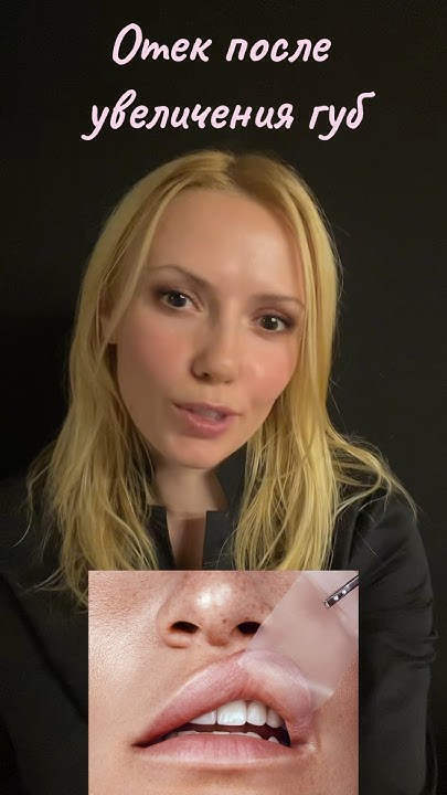 Сколько держится отек после увеличения губ Youtube