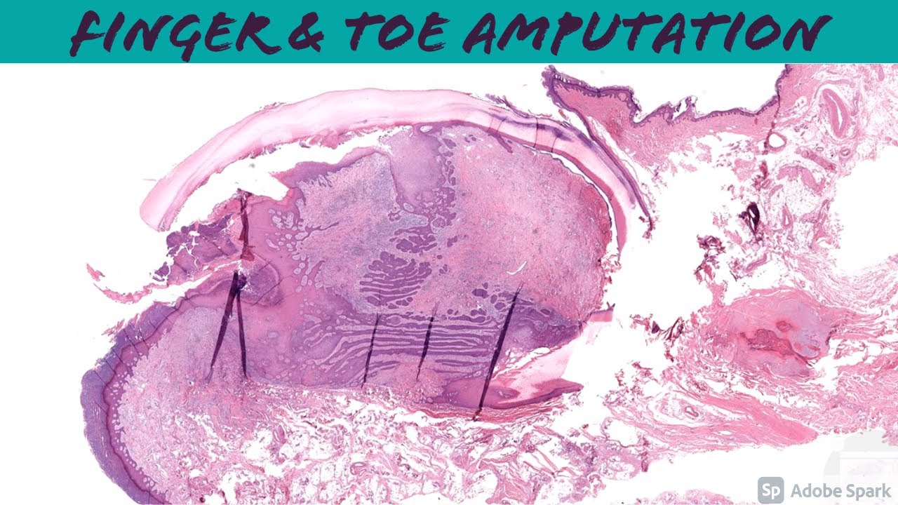 Finger & Toe Amputation Specimens under the microscope (Histology ...
