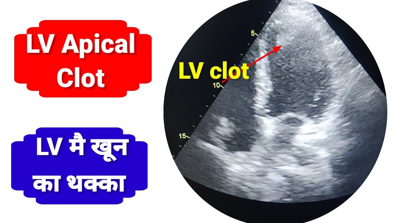 LV मैं खून का थक्का ll LV Apical Clot in Echocardiogrphy - YouTube