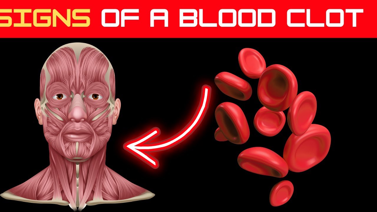5 Major Signs of Blood Clots in Your Legs to Be Aware Of - YouTube