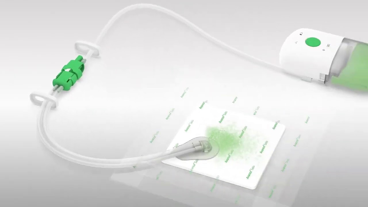 Avance solo: sistema terapeutico a pressione negativa, modalità di ...