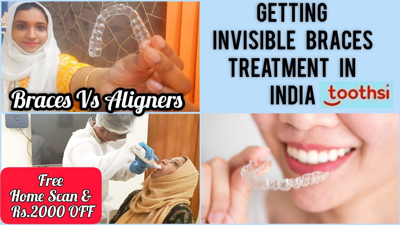 My Invisible Aligners Treatment with TOOTHSI |Toothsi Aligners Tamil ...