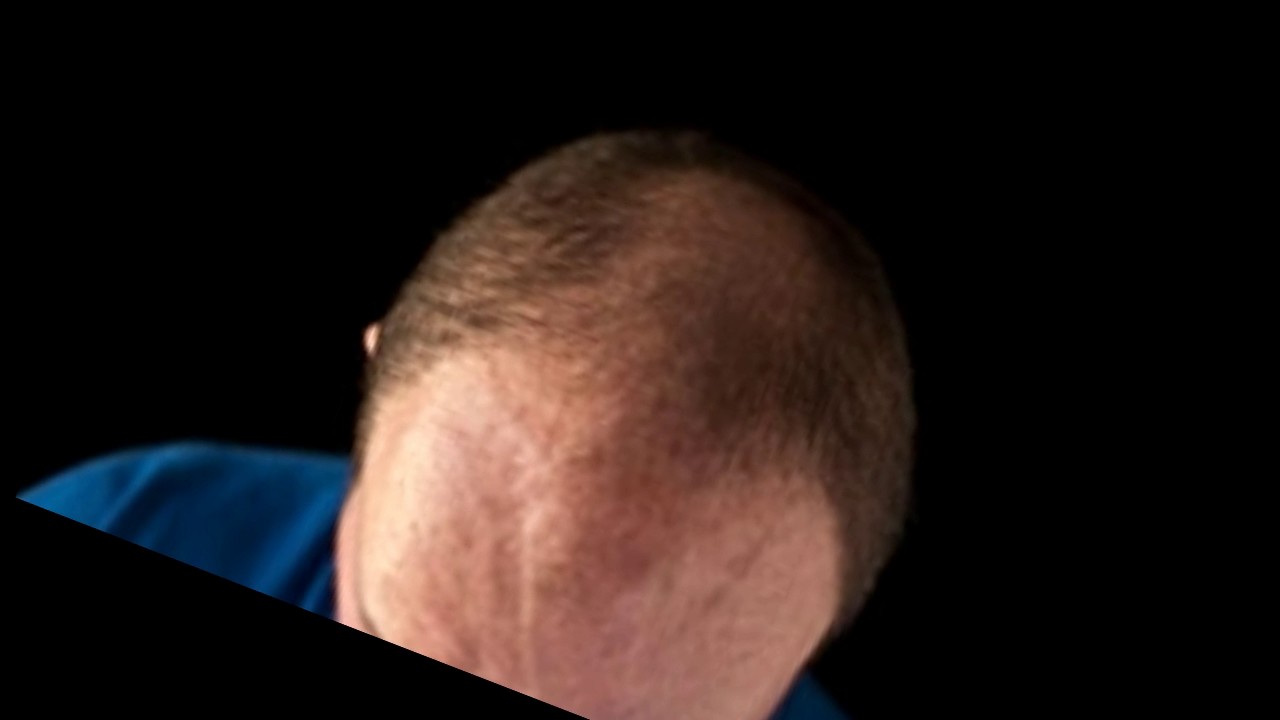 Major Causes Of A Lump Formation On The Scalp And Its Treatment YouTube major-causes-of-a-lump-formation-on-the-scalp-and-its-treatment-youtube