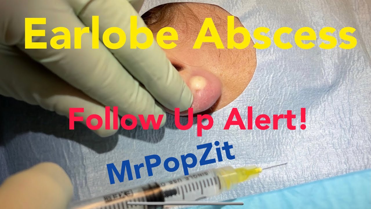 follow-up-alert-4-weeks-post-abscess-drainage-on-earlobe-healing