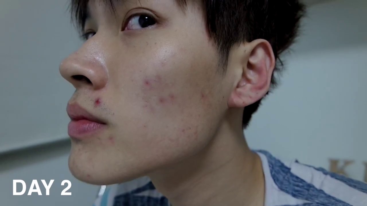 [Update] Acne Journey - Kife wee - YouTube