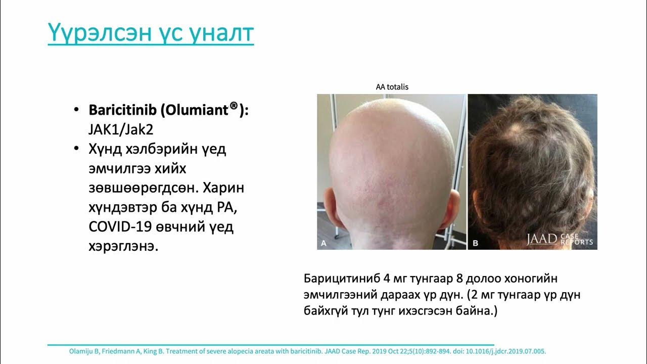 Арьсны зарим өвчний үед хэрэглэгдэх шинэ эмнүүдийн тухай 2 Youtube