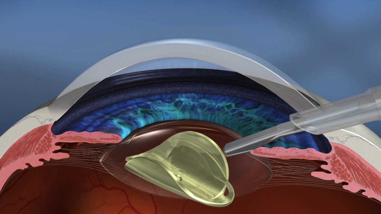 LenSx Vs Standard Phaco Animation - YouTube