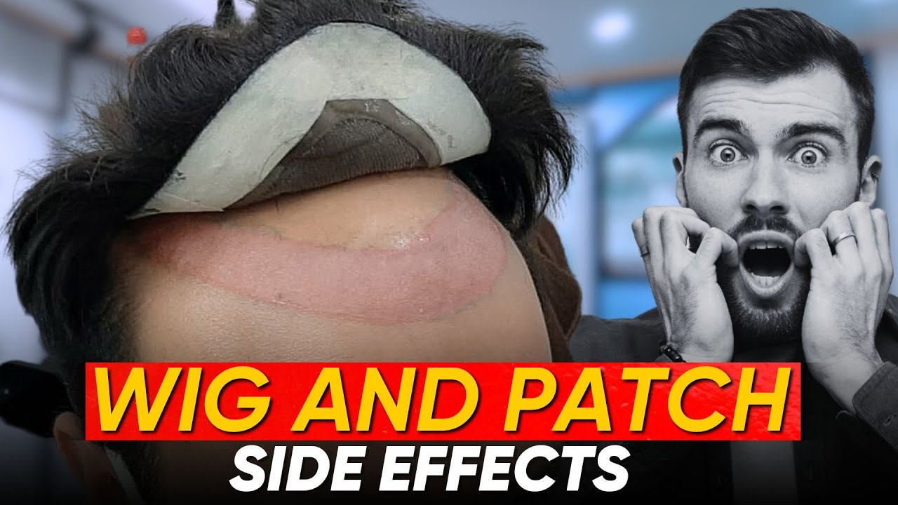 Hair Patch | Side Effects of Hair Patch & Wig - YouTube