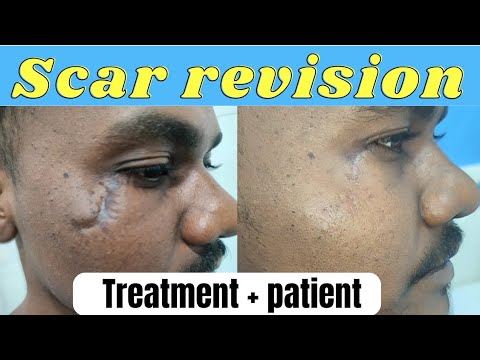Scar revision surgery - Result after 5 months| Scar revision surgery in ...