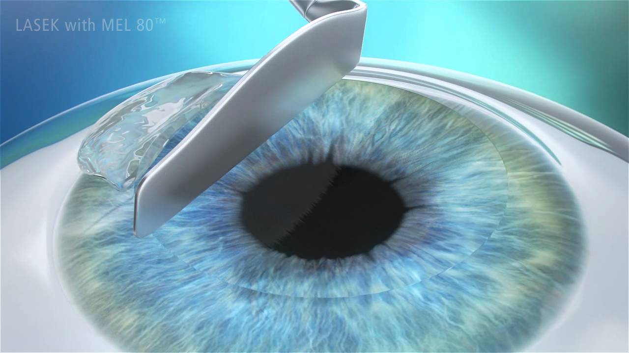 Zeiss 04 LASEK Final Lang Logo 11 07 12 1 - YouTube