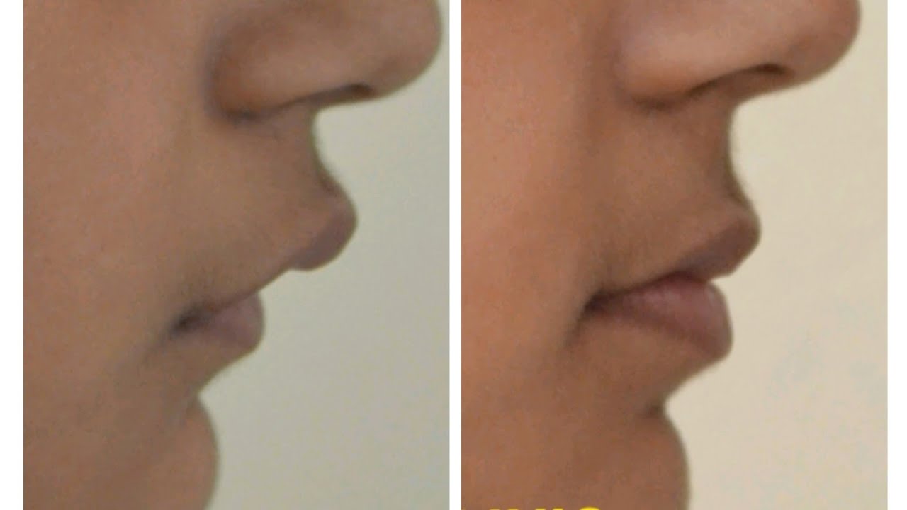 "Astonishing Face Makeover: Embrace Braces for a Stunning ...