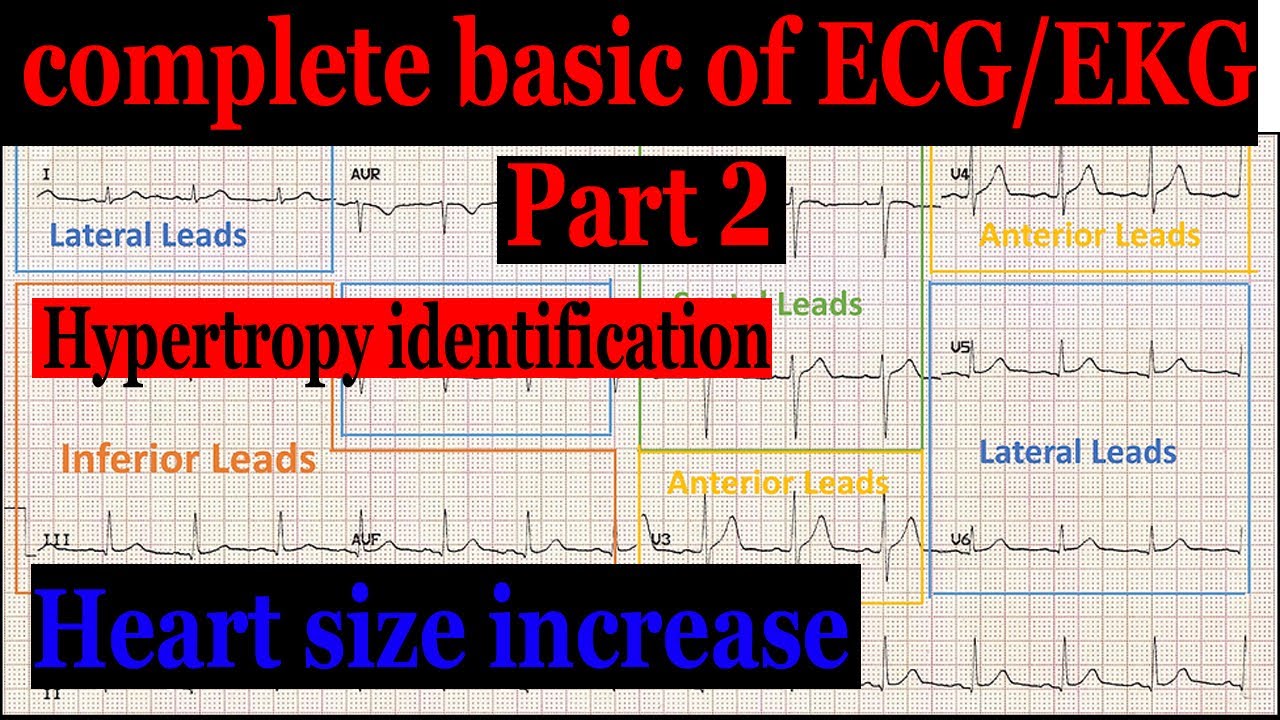 ECG hypertrophy of right and left atria and ventricle - YouTube