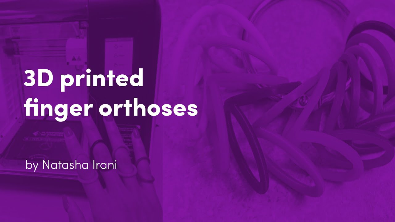 3D Printed Finger Orthoses - YouTube