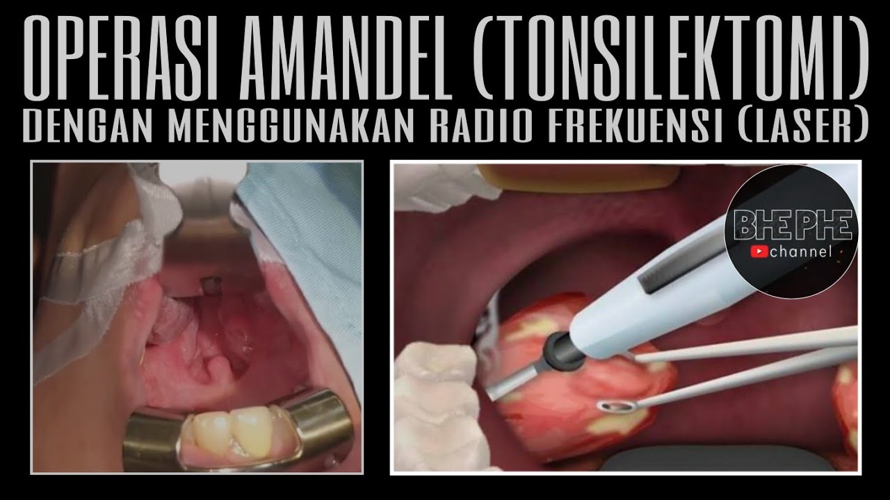 Operasi Amandel dengan Laser Radio Frekuensi - YouTube