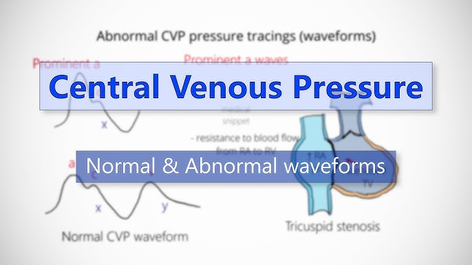 Central Venous Catheter Placement CVC Insertion, 55% OFF