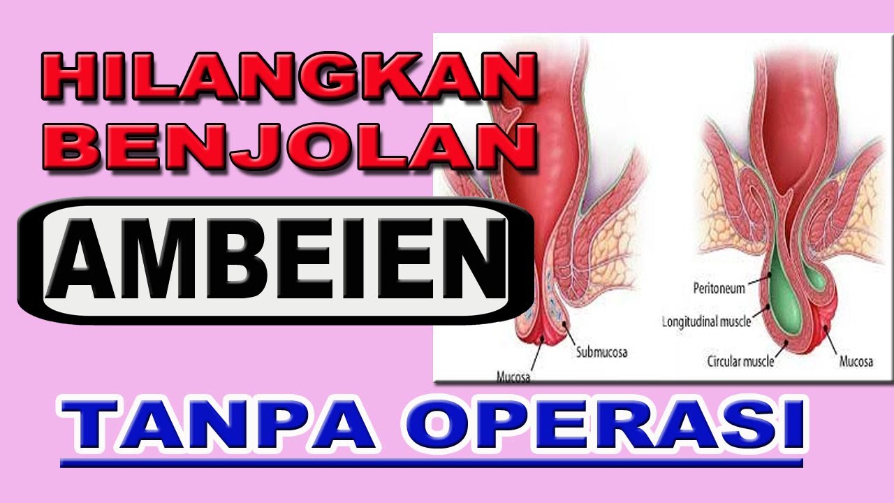 Bisakah Menghilangkan Benjolan Ambeien Tanpa Operasi - Obat Ambeien ...