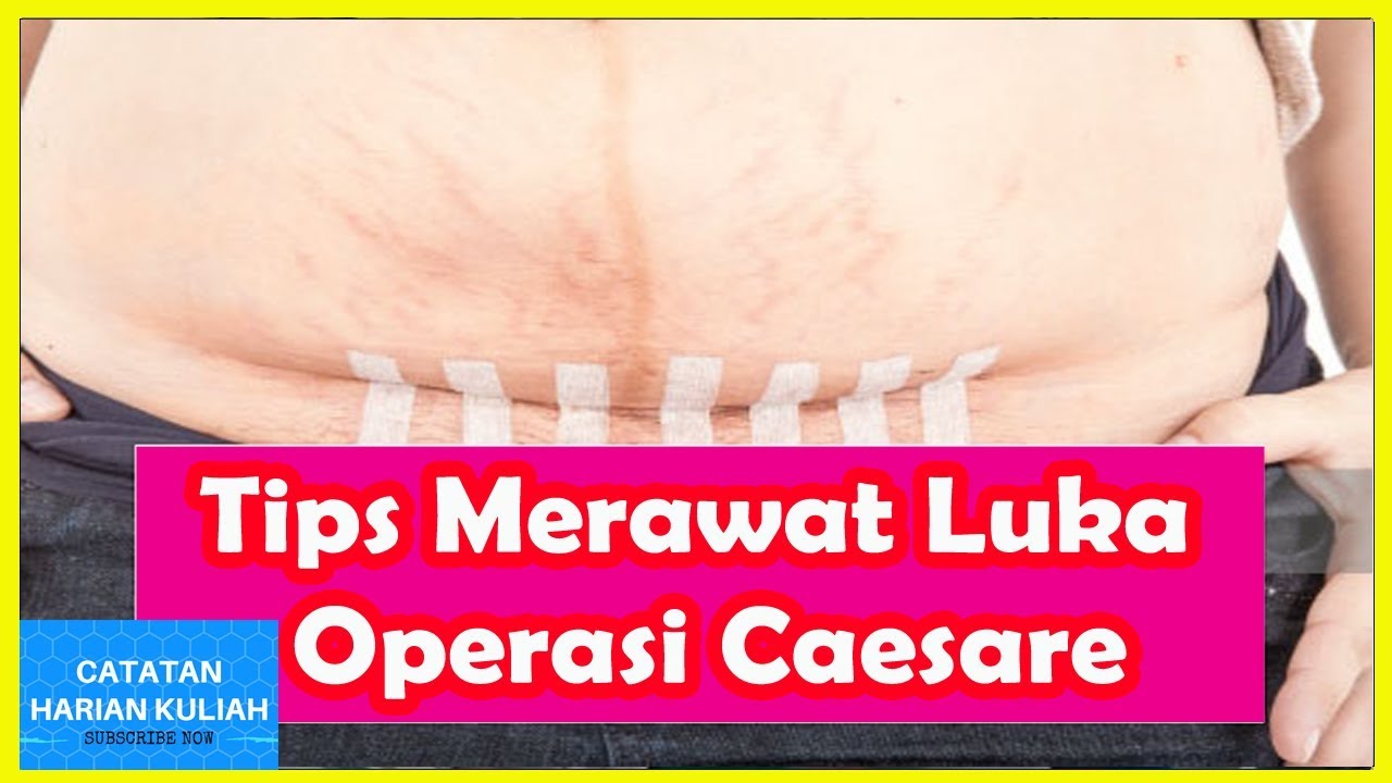 Harus Tahu!!! Cara Perawatan Luka Post Sectio Caesarea untuk ...