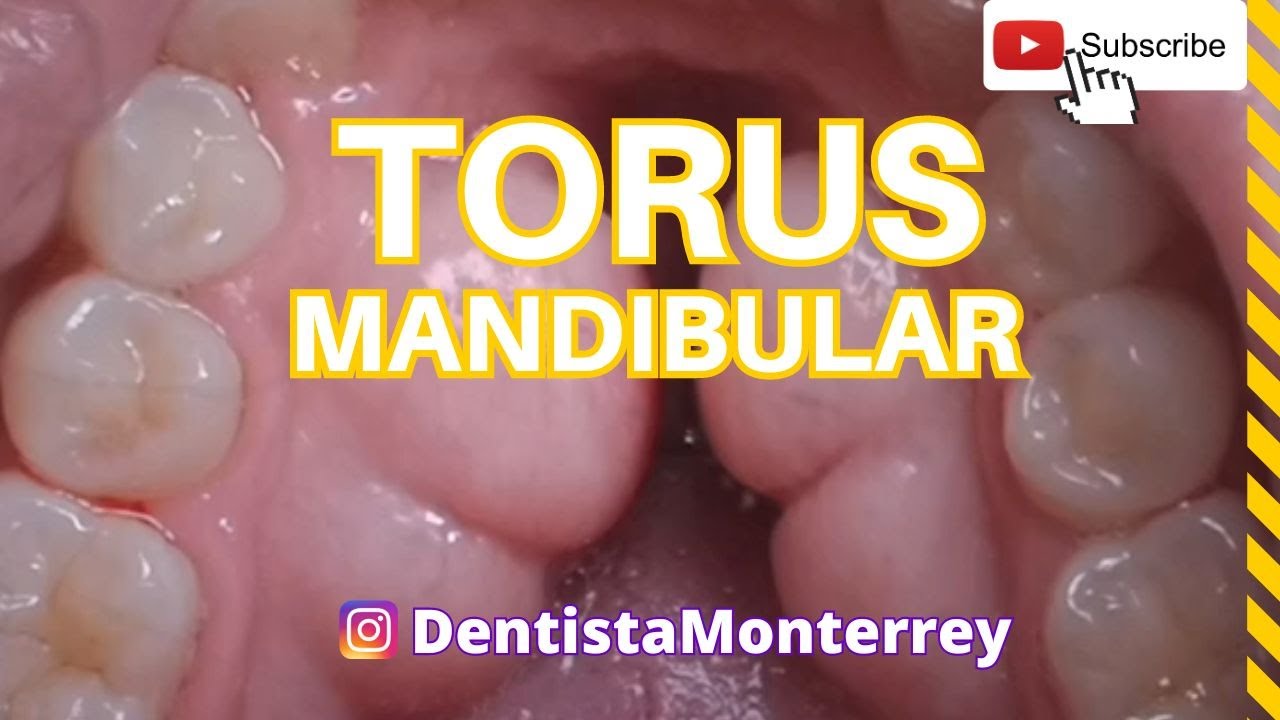 🤔 Que Es el TORUS Y CÓMO TRATARLO 👅Rodete Mandibular - YouTube