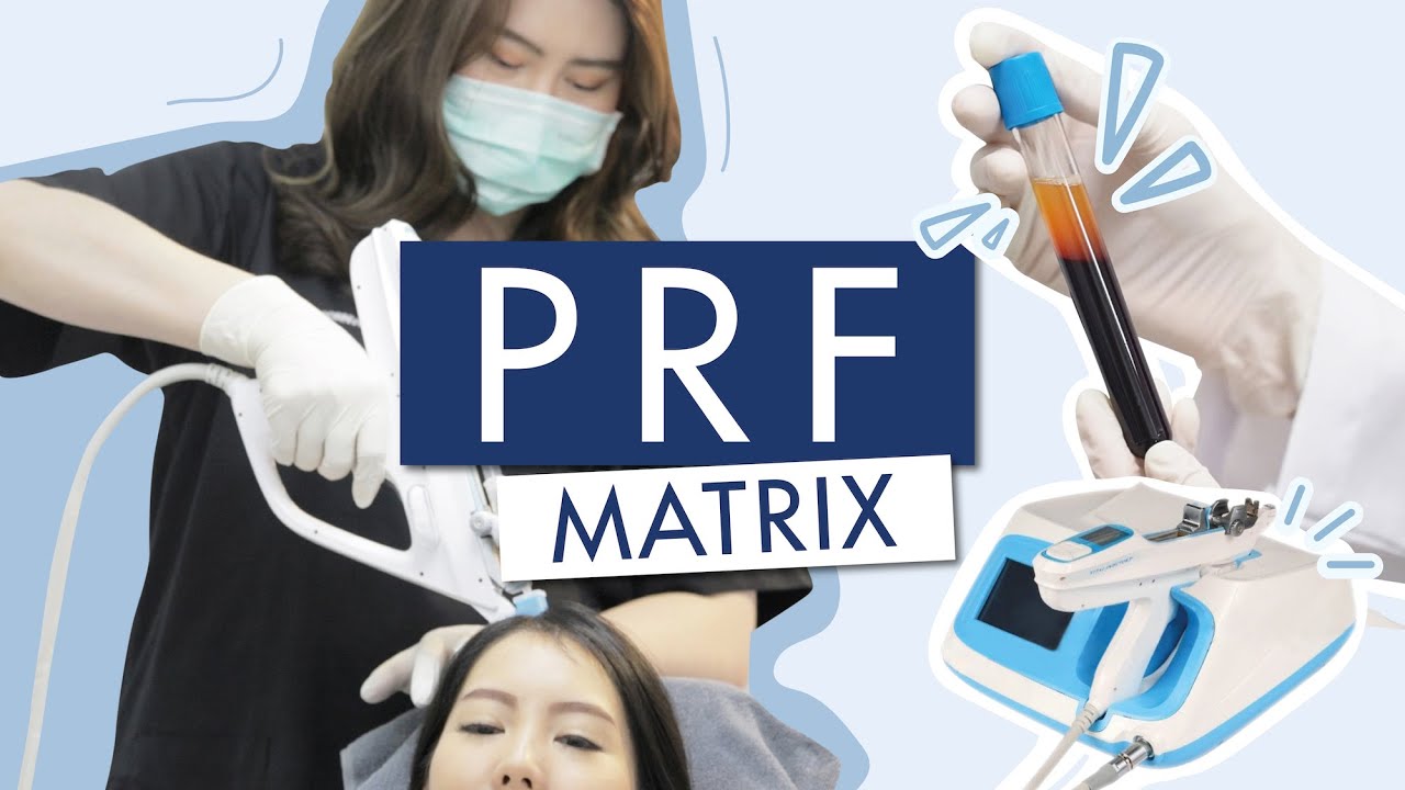 PRF MATRIX ฉีดกระตุ้นรากผม เร่งการงอก เห็นผลกว่า PRP 10เท่า !! - YouTube