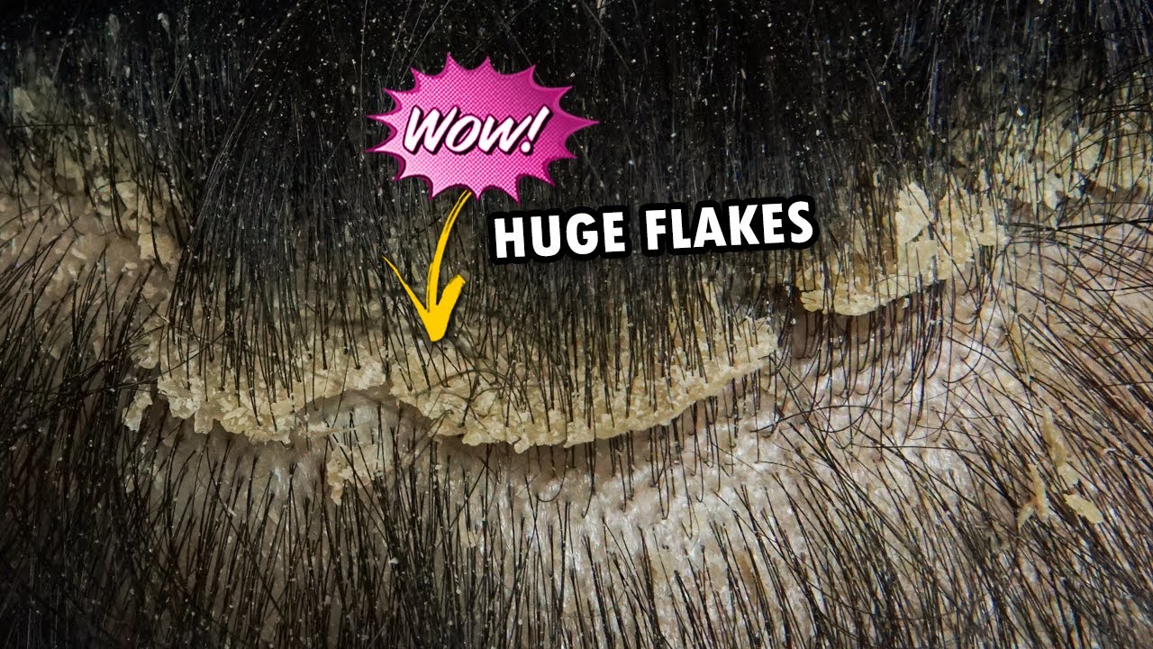 HUGE Dandruff Flakes Removal Satisfying on Back Side #380 - YouTube
