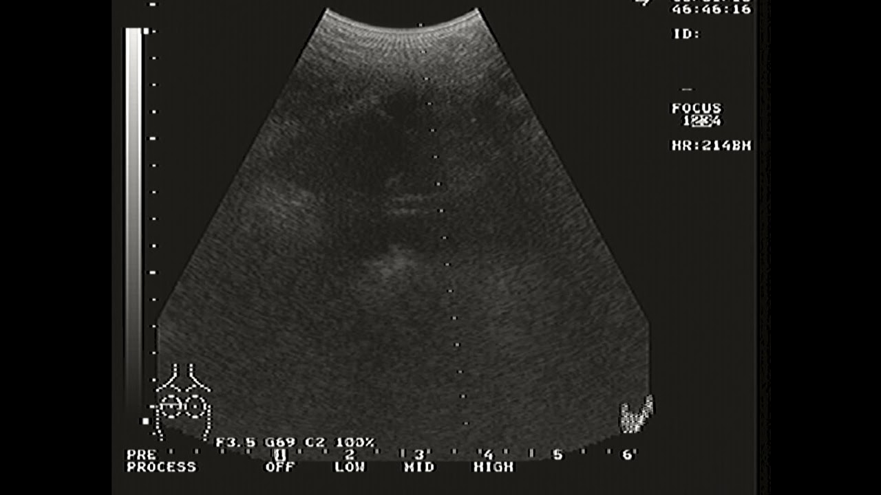 Female heart, ultrasound view, heartbeatsound - YouTube