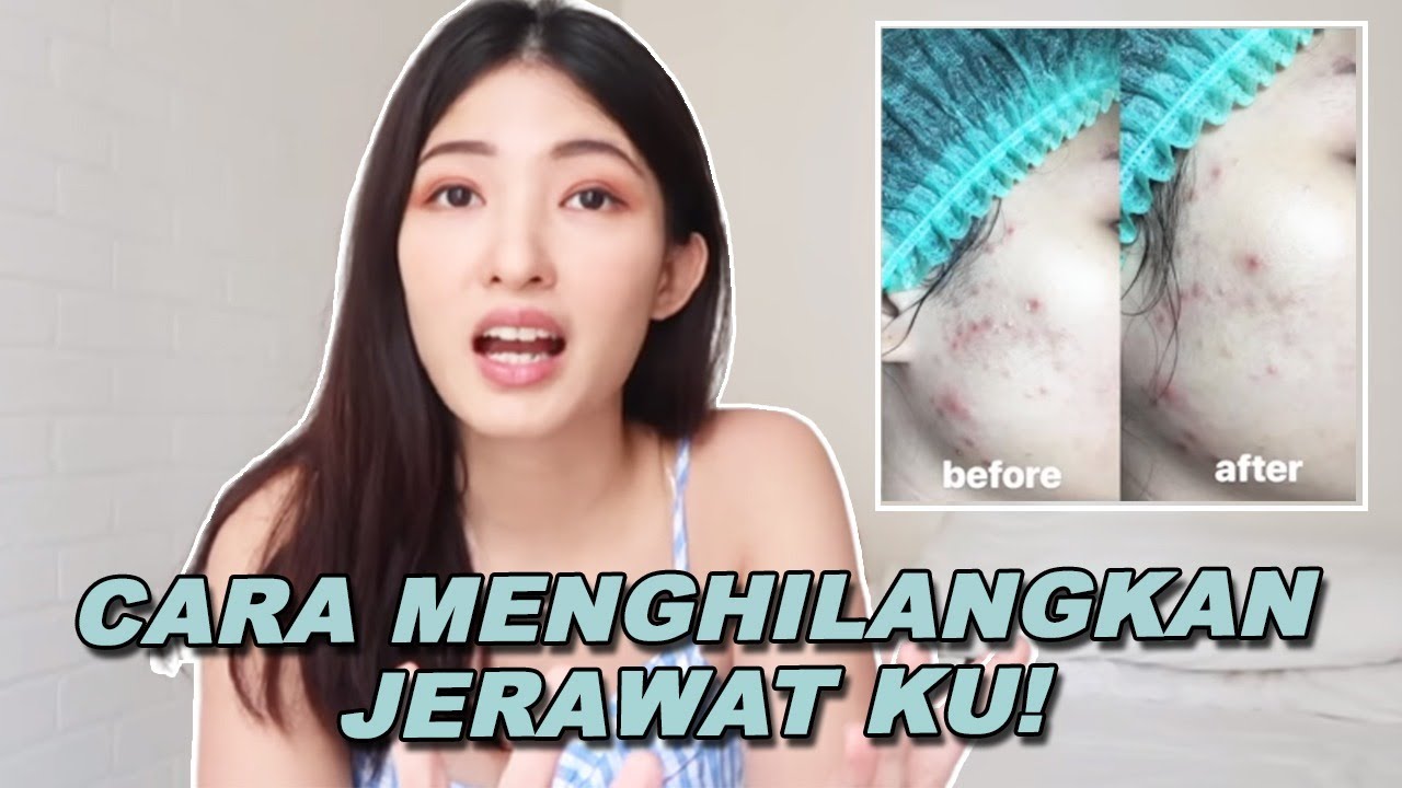 Cara Menghilangkan Jerawat Jerawatku Yang Membandel Youtube