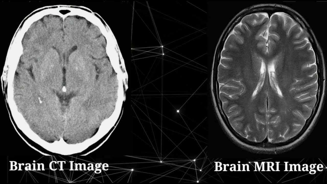 What's the difference between MRI and CT Scan? || Radiology Buzz - YouTube