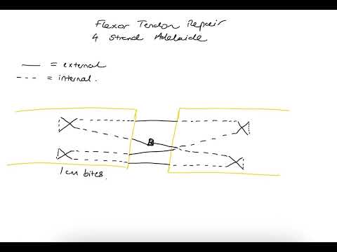 How to draw flexor tendon repair - 4 strand Adelaide suture technique ...