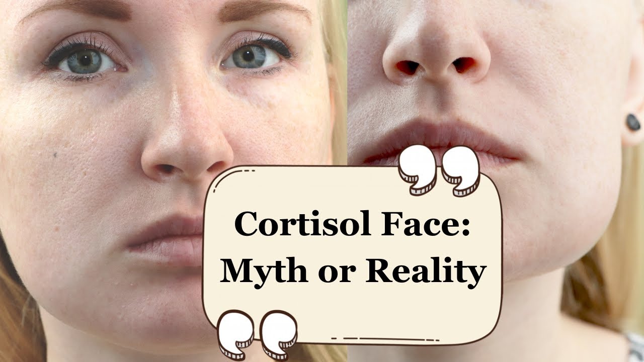 What Is Cortisol Face Myths, Causes, and Differences - YouTube