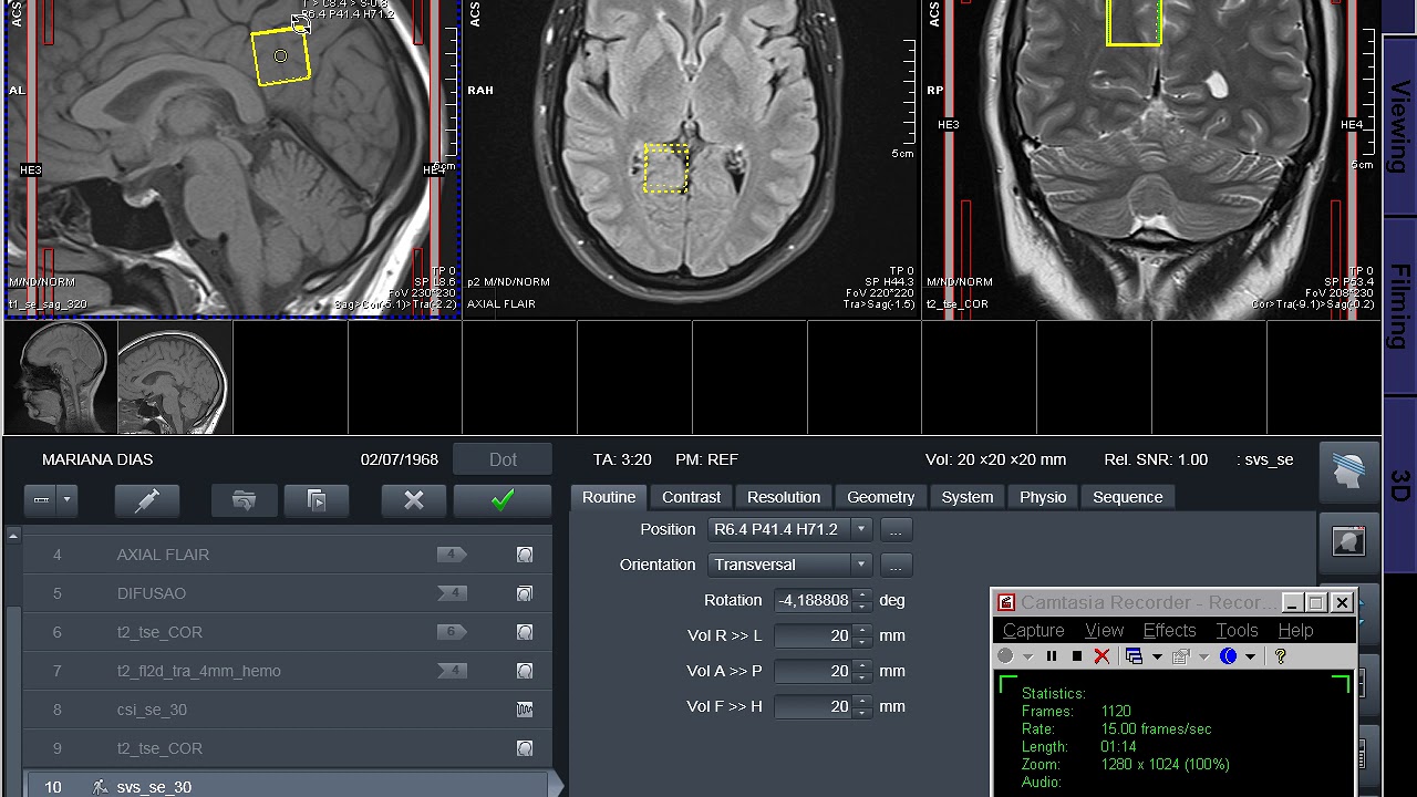 Espectroscopia single voxel giro do cinculo (cortex pariteal posterior ...