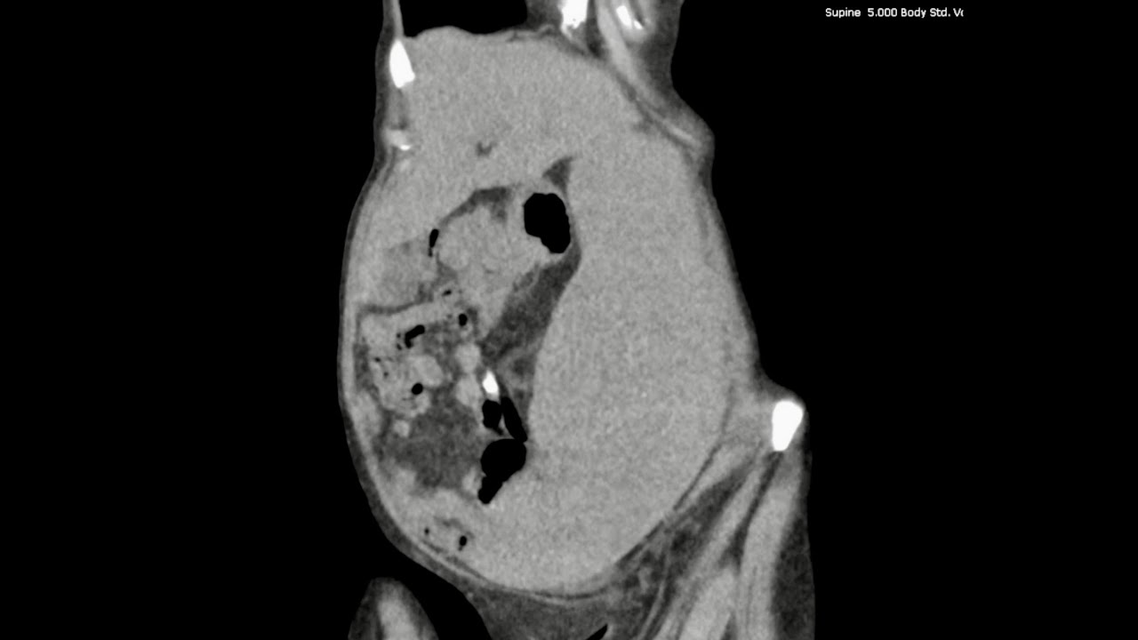 Laparoscopic Splenectomy #3: Giant spleen with intact delivery - YouTube