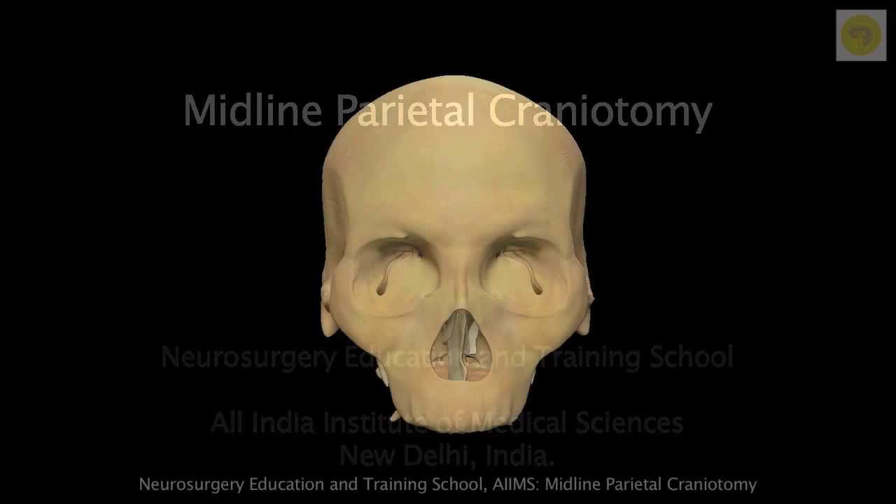 Neurosurgery 3D Animation Video : Midline Parietal Craniotomy - YouTube
