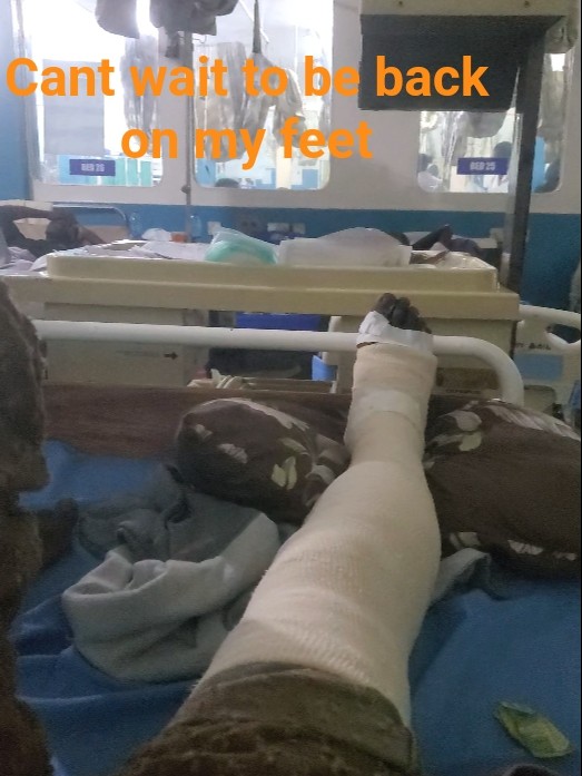 about a week now since I broke my tibia🦴 in an accident 🤦🏾‍♂️.crazy how ...
