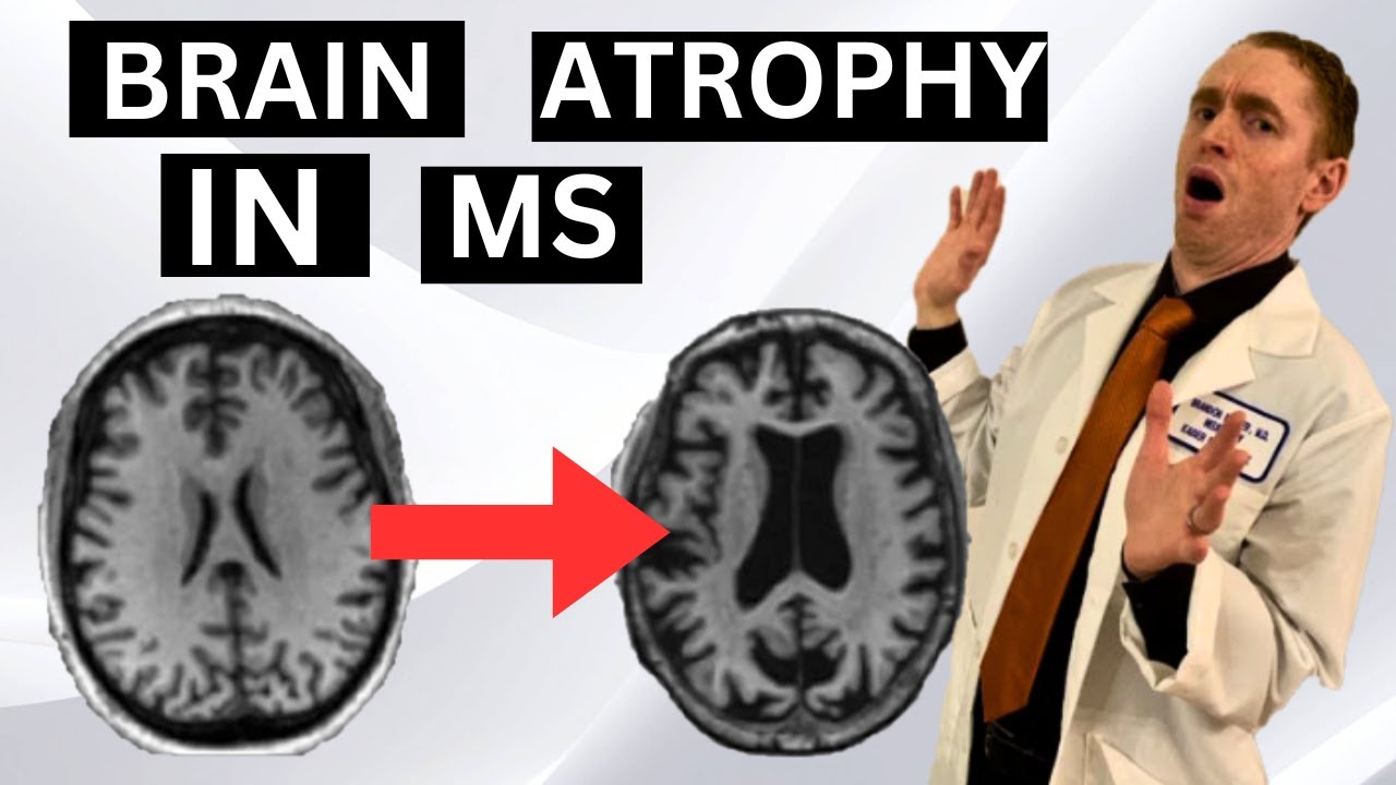 Brain Atrophy in Multiple Sclerosis Explained by Neurologist - YouTube
