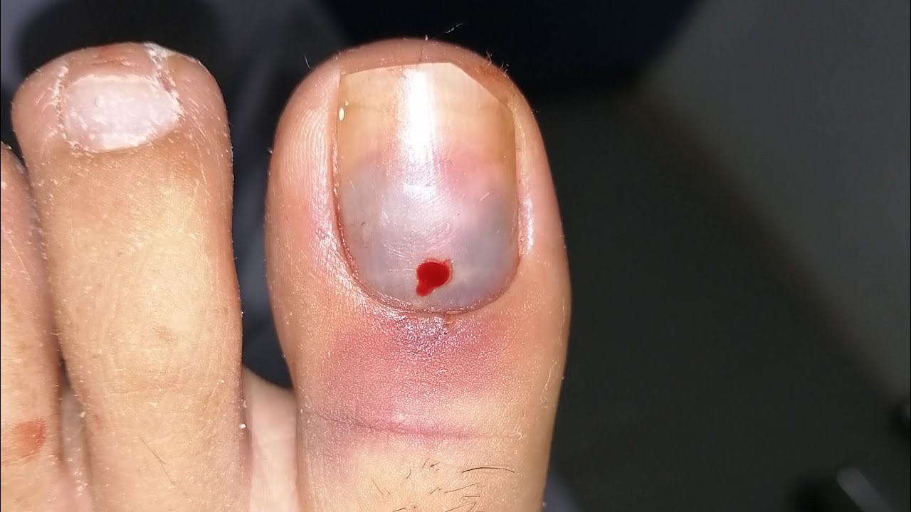 Golpe en dedo del pie (Hematoma subungueal) - YouTube