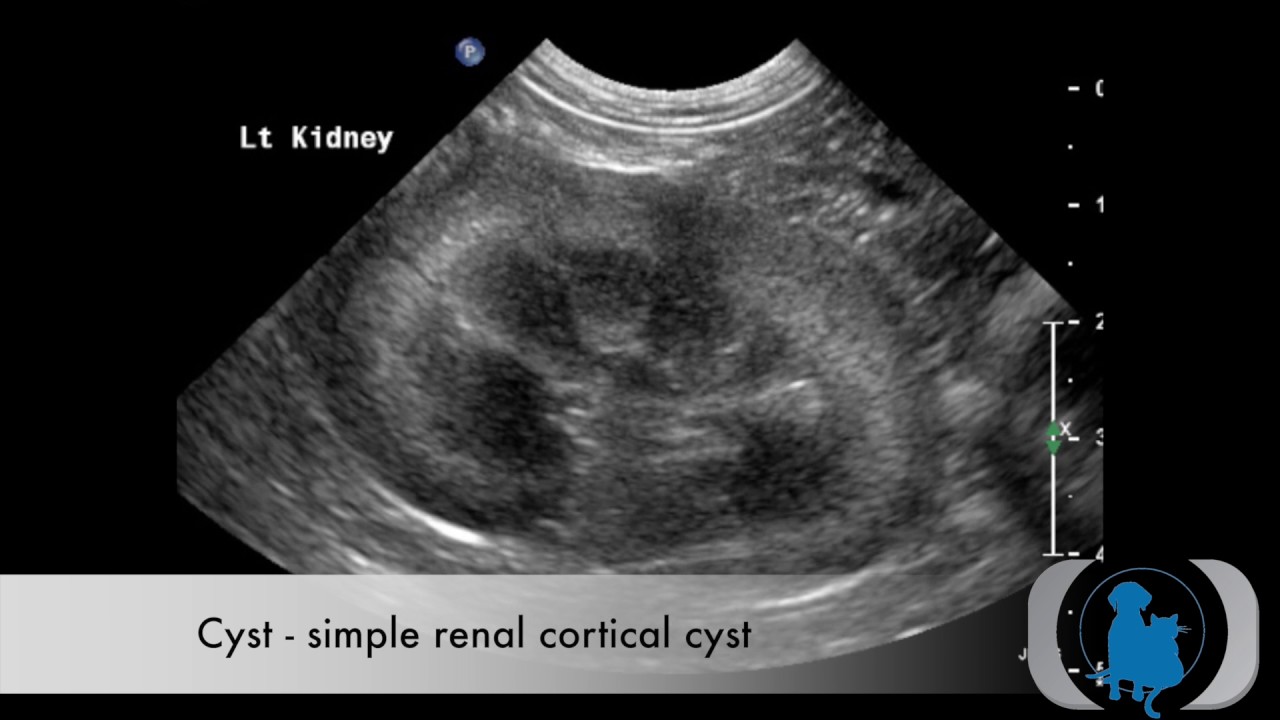Simple Renal Cortical Cyst YouTube Simple Renal Cortical Cyst YouTube