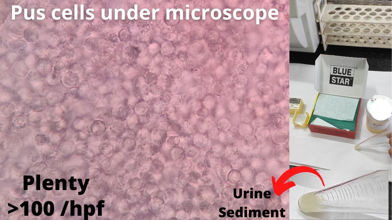 Pus cells in urine | Urinary tract infection | UTI ...