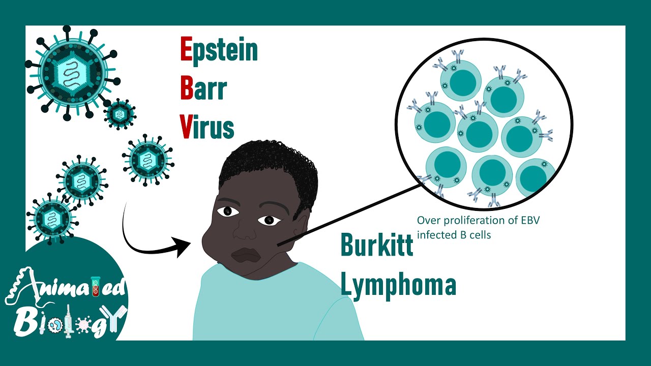 Burkitt Lymphoma and Epstein-Barr Virus Infection: Pathology and Diagnosis? - YouTube