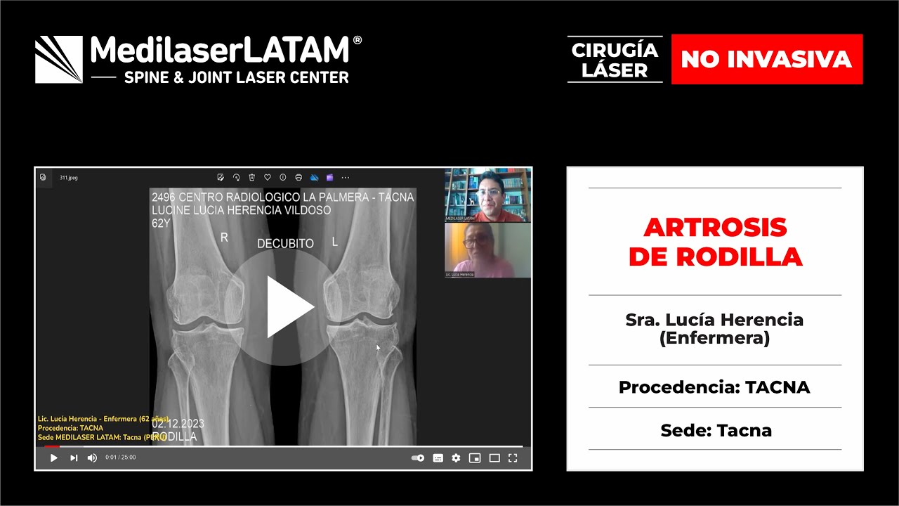 Artrosis de Rodilla | TESTIMONIO | Medilaser LATAM - YouTube