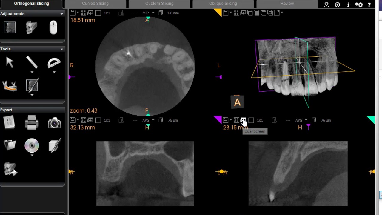 cbct Carestream 3D imaging software - YouTube