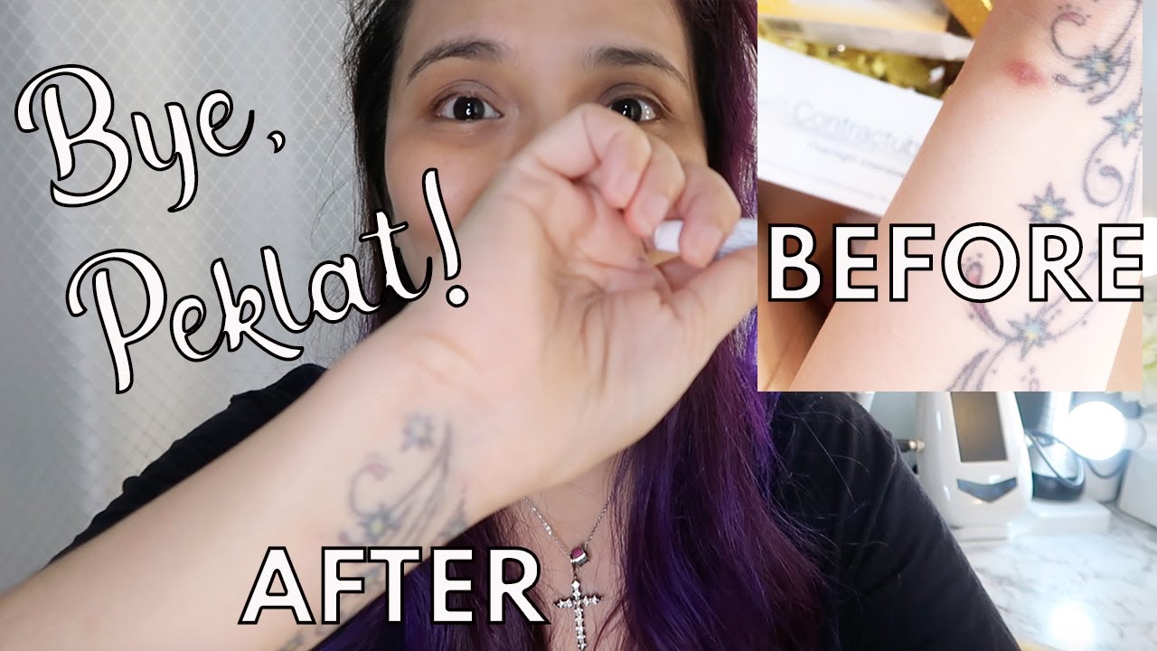 How I got rid of my scar ️(Paano mawala ang peklat? Contractubex Review ...