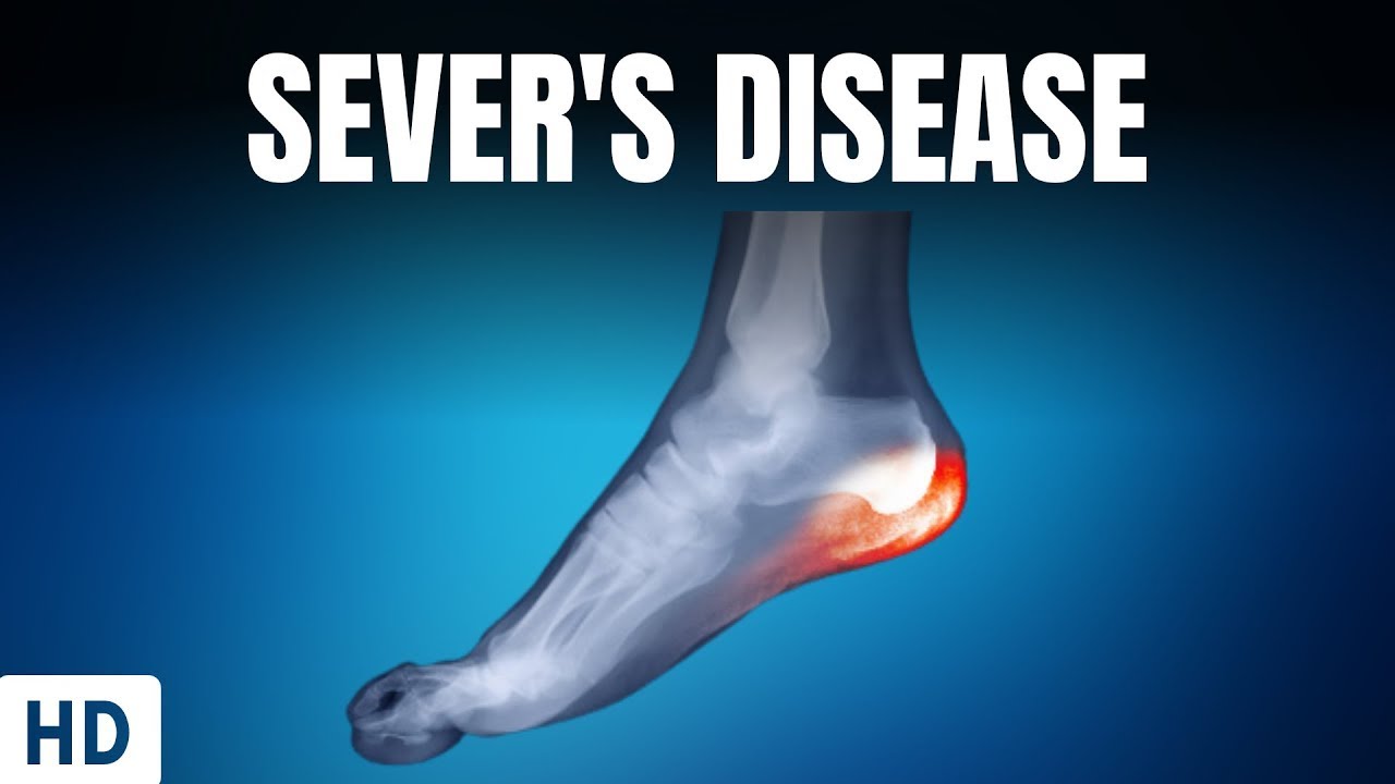 Sever's Disease | Everything you need to know - YouTube