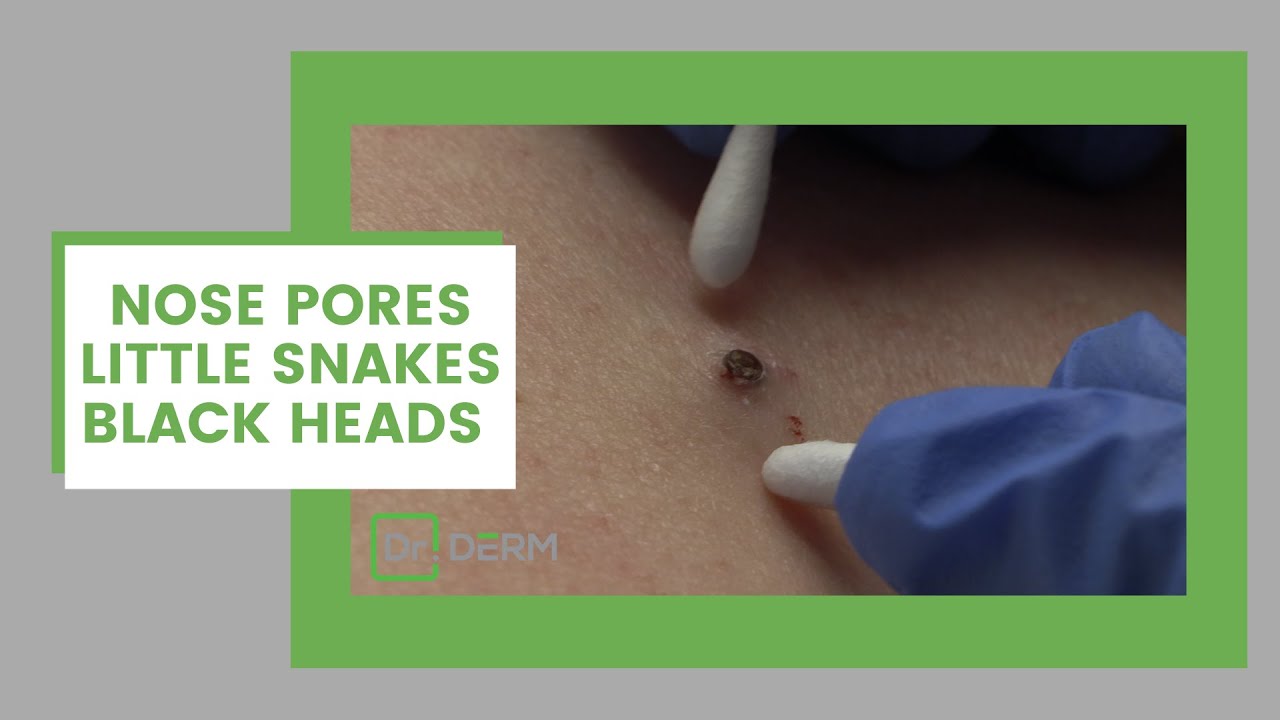 A compilation of nose pores, little snakes and black heads | Dr. Derm ...