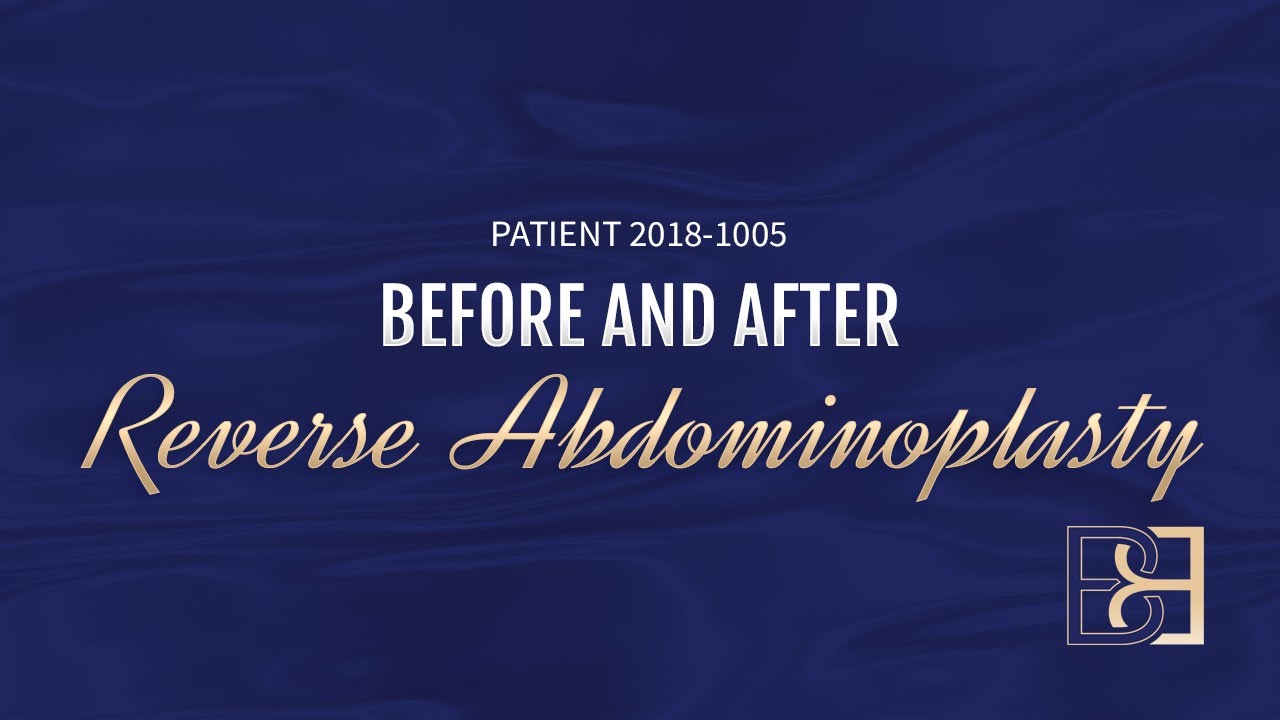 Reverse Abdominoplasty {Patient 2018-1005} Before & After - YouTube