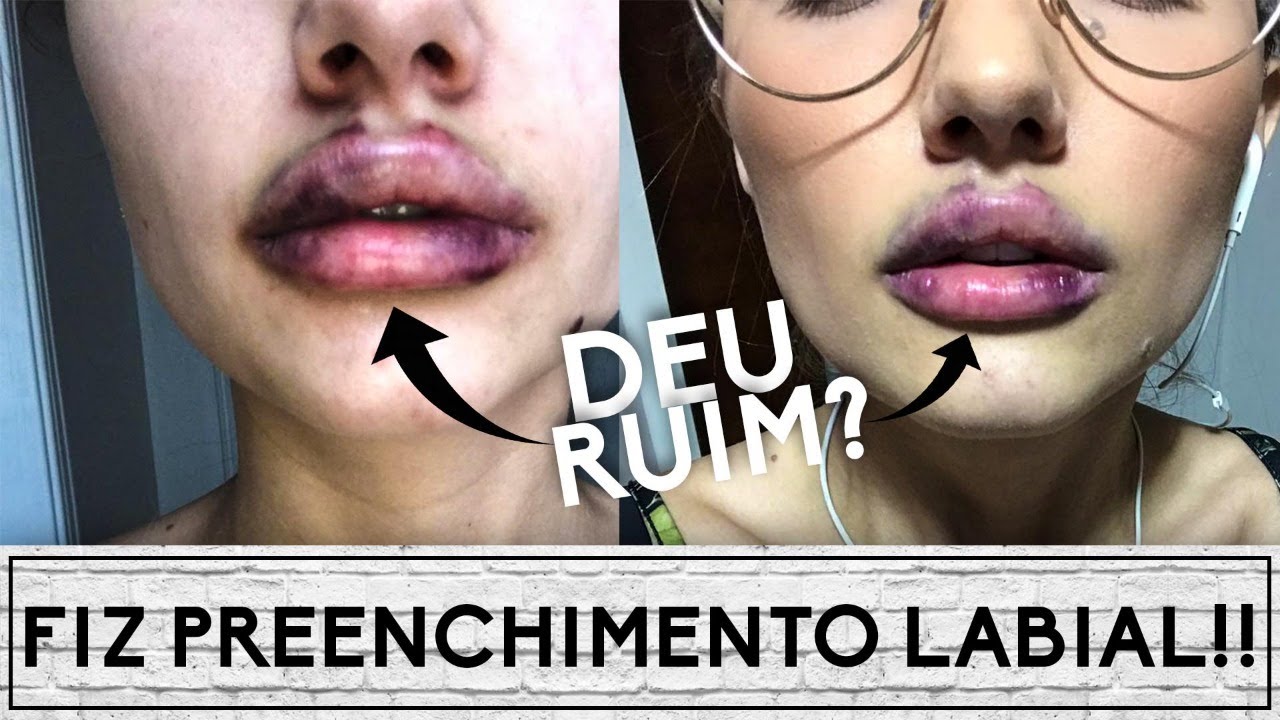 Meu Preenchimento Labial Youtube